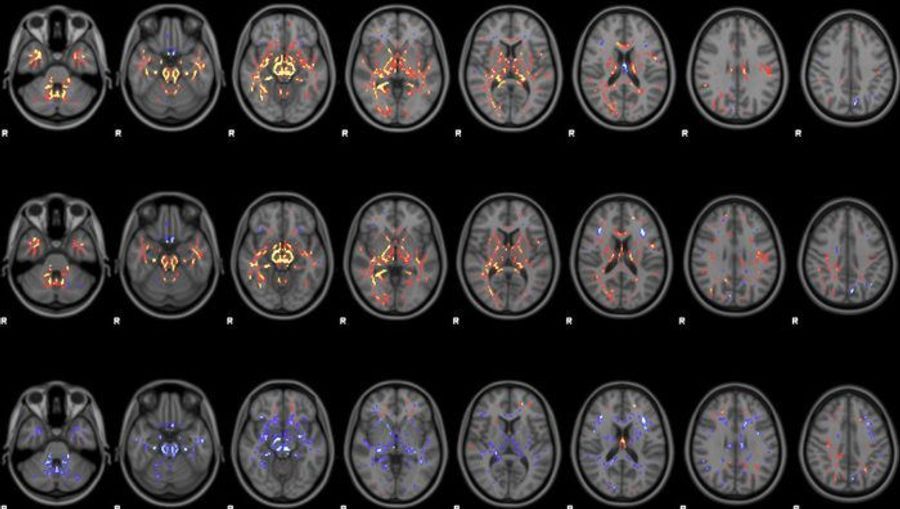 MRI Technique Shows Unique Signatures of Concussion in Rugby Players ...