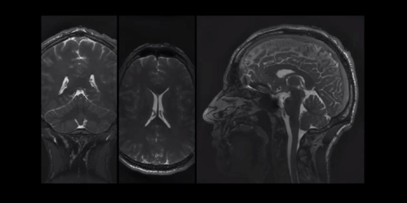 New MRI Technique Captures Brain Movement in Stunning Detail | Today's ...
