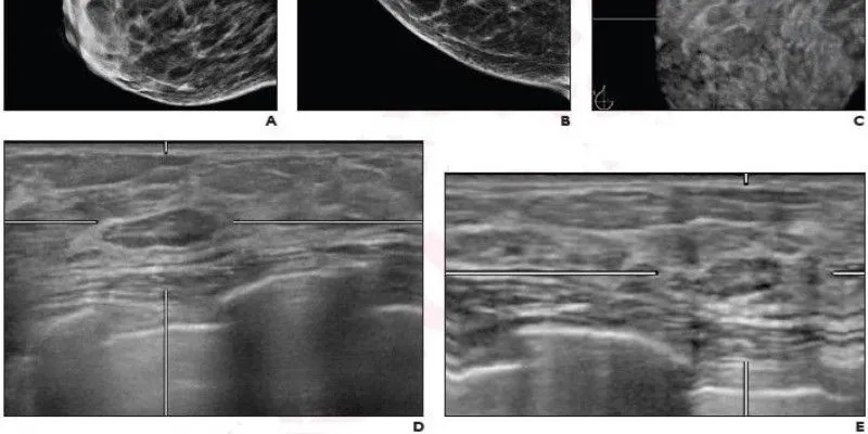 Routine Screening for BI-RADS Lesions on Automated Whole-Breast ...