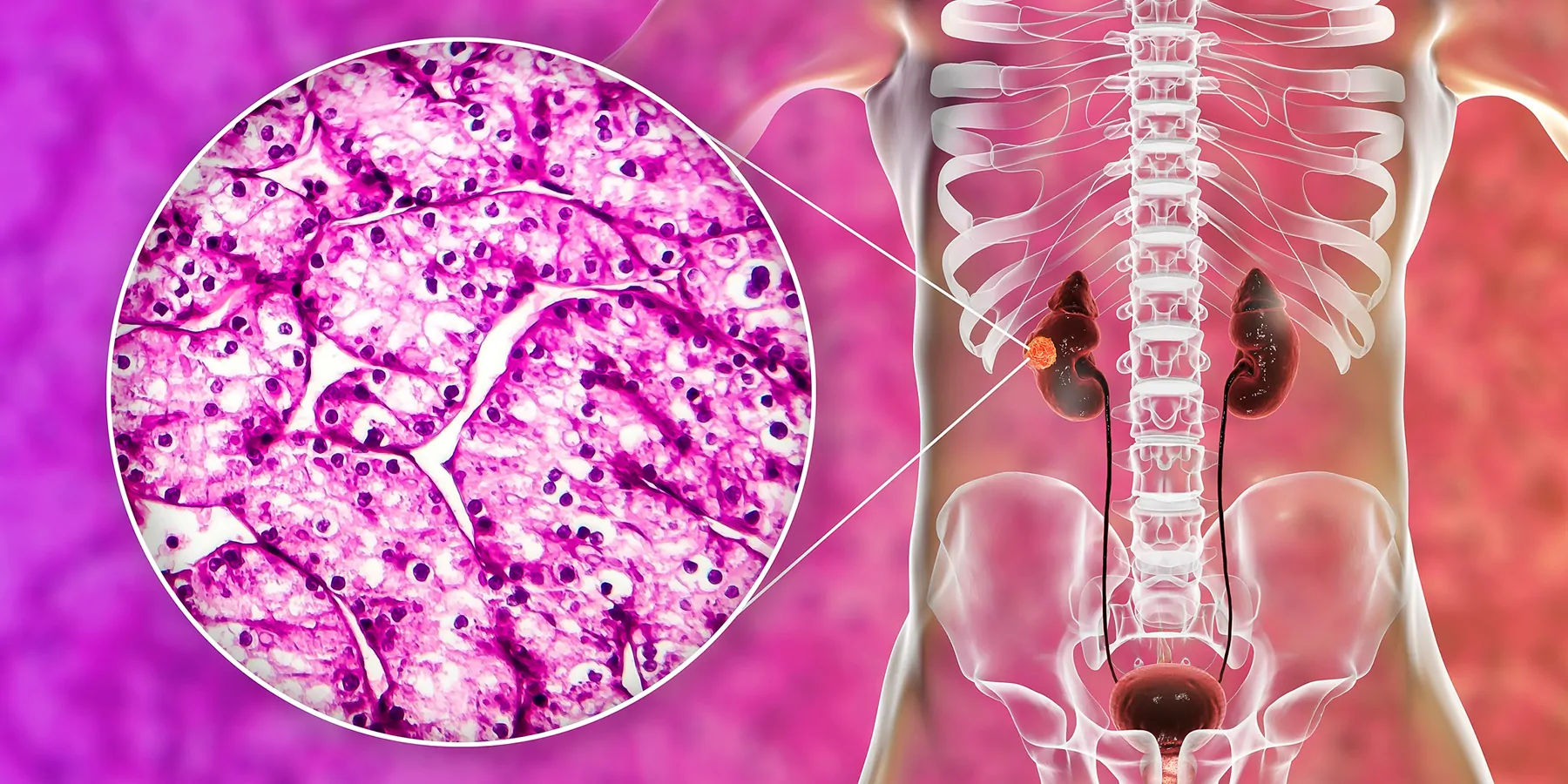 Tissue Atlas to Advance Personalized Kidney Disease Treatment | Today's ...
