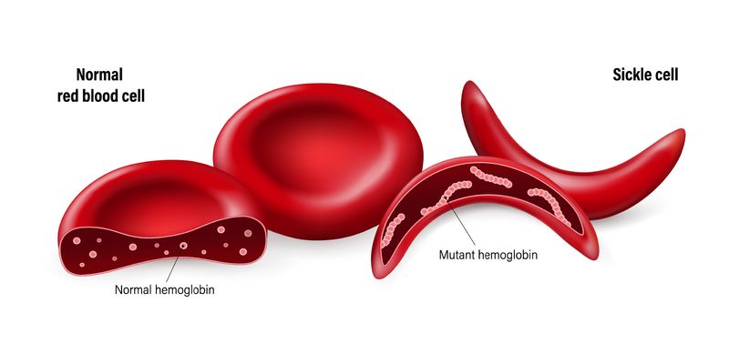 FDA Approves First Gene Therapies for Sickle Cell Disease | clinicallab