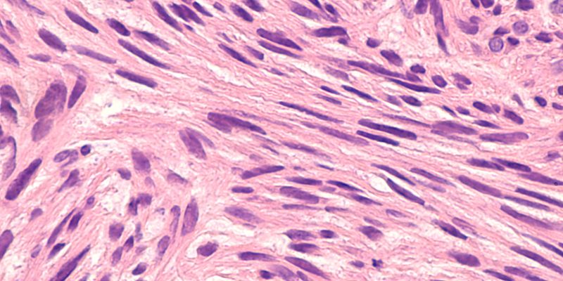 Neoadjuvant Immunotherapy Shows Positive Results in Sarcoma Trial | clinicallab
