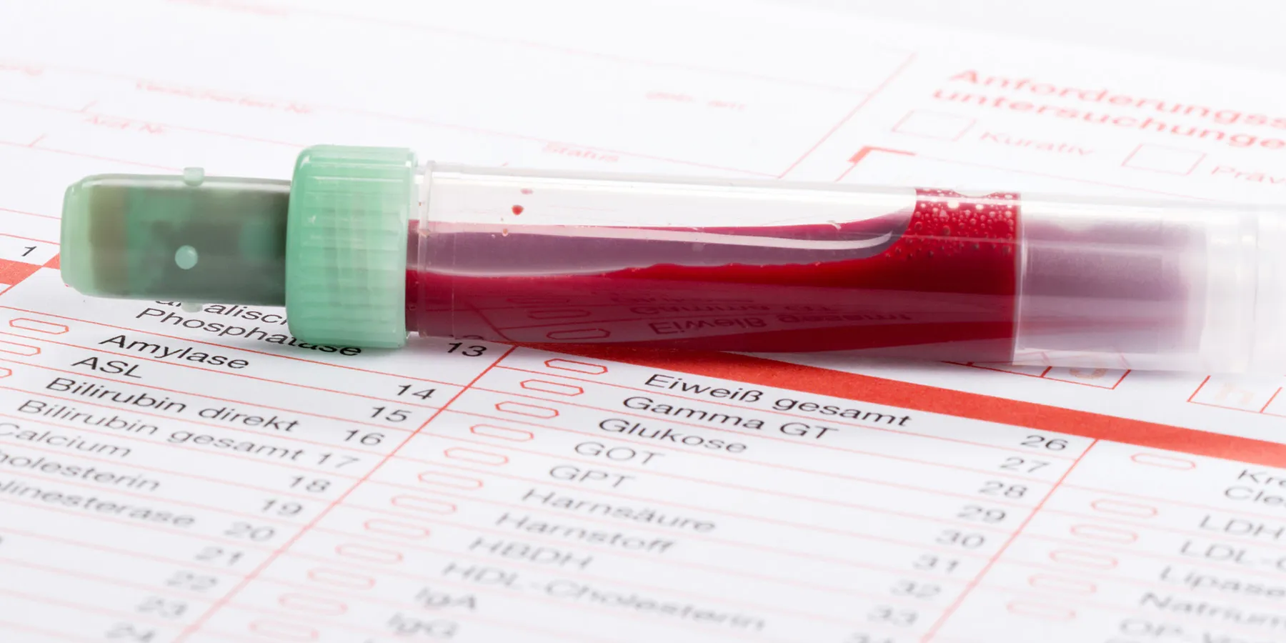 Blood Biomarkers in Patients with Arthritis Predict CVD Risk | clinicallab