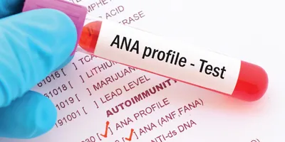 The Nuances of Antinuclear Antibodies Testing in Rheumatologic Diseases ...