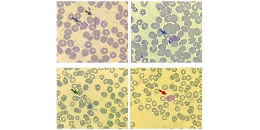 Researchers Identify Biomarkers of Malaria Recurrence in Patient Blood ...